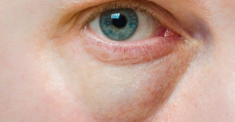 Uncle Fester, angry liver & my dark eye circles