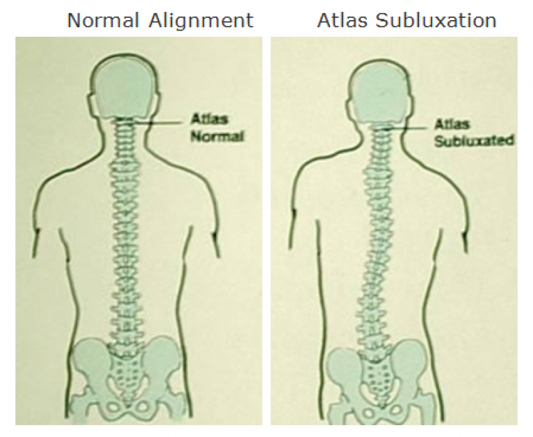 Forward head posture & headaches